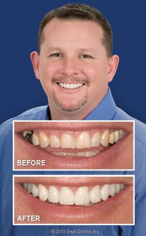 Same-Day Smile Makeover | Quick Smile Transformation